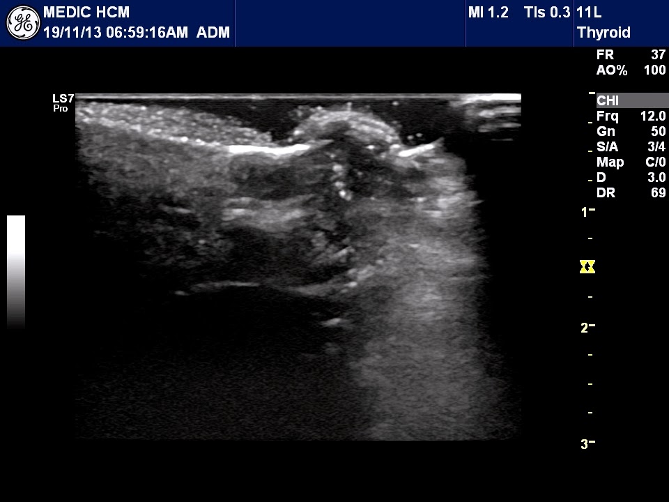 VIETNAMESE MEDIC ULTRASOUND: CASE 221:ELASTOSCANNING of FACIAL SKIN ...