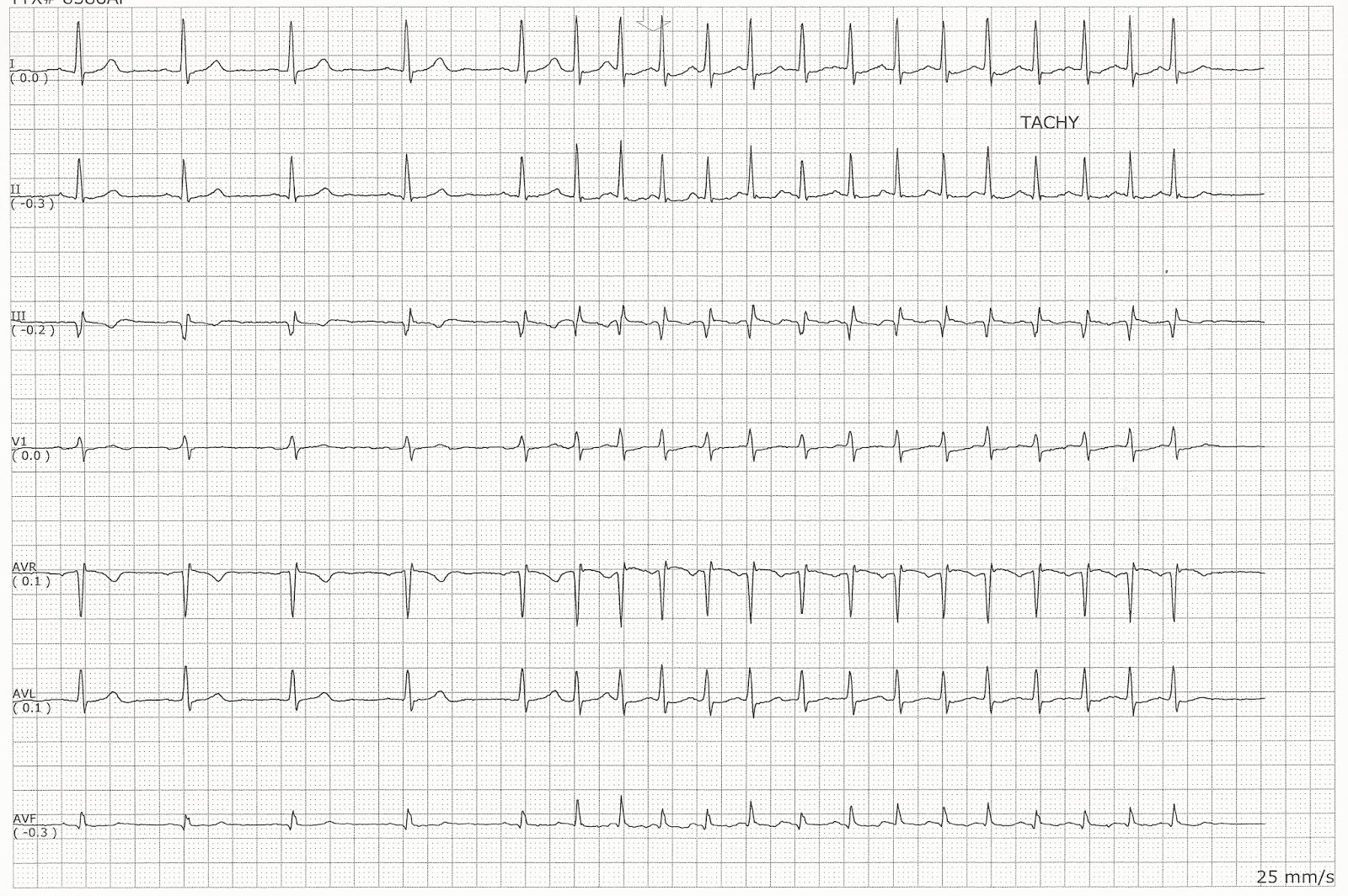 Sinus rhythm changing to SVT