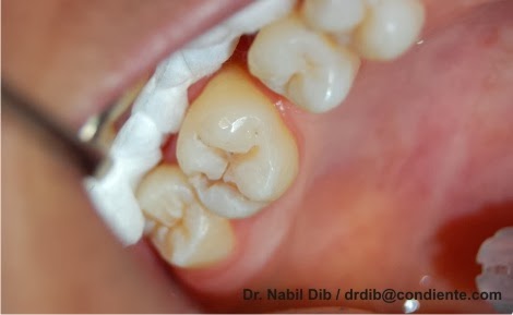 Dr. Nabil Dib: Restauración Minimamente Invasiva con el uso de Dyad ...