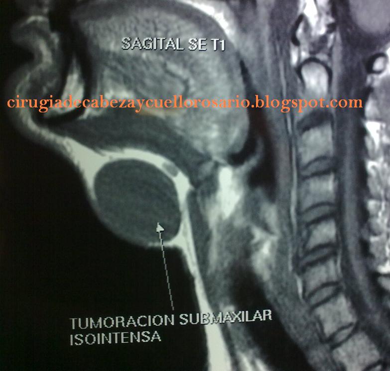 Cirugía de Cabeza y Cuello Rosario: LIPOMA