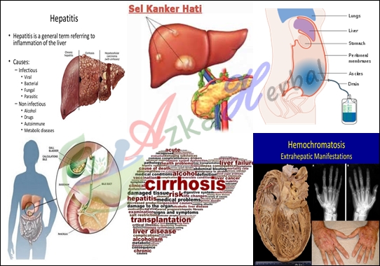 Cara Mengobati Gangguan Fungsi Hati 100 % Ampuh - Solusi Atasi Penyakit ...