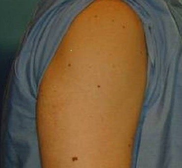 Photos of Moles on Hand Arm and Leg ~ How To Remove Moles, Warts, Skin ...