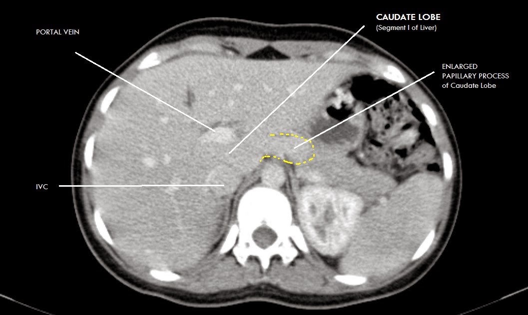 Ultimate Radiology : Pseudolesion : Papillary Process of Caudate Lobe