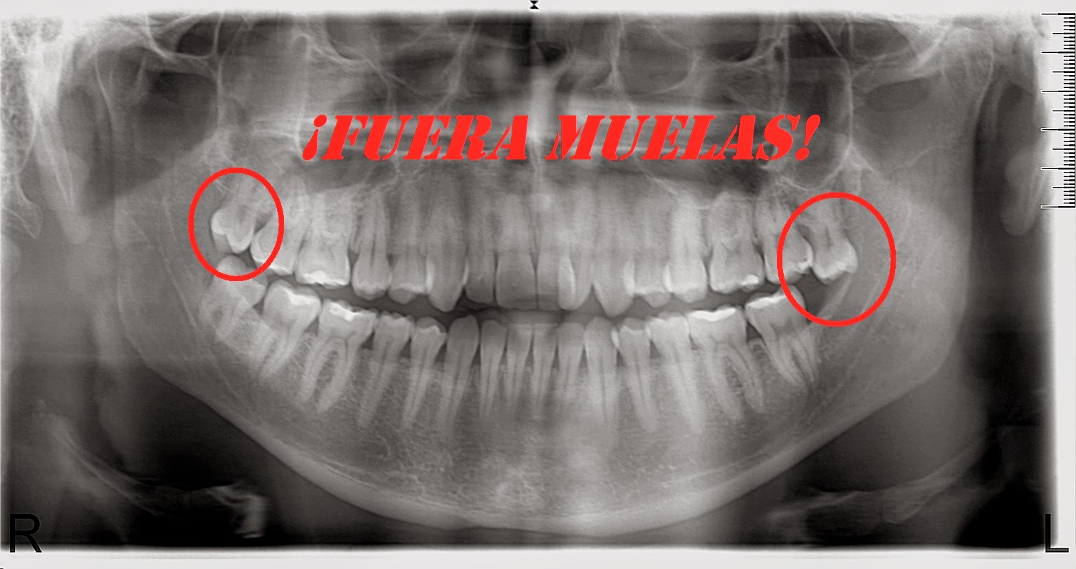 Mi Ortodoncia Invisalign: 2014