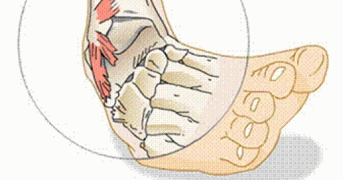 Živi Zdravo: Kako brzo i efikasno izliječiti uganuće zgloba?