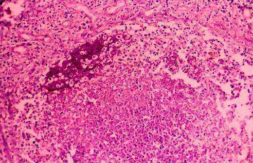 Patologia Humana: Inflamación Aguda