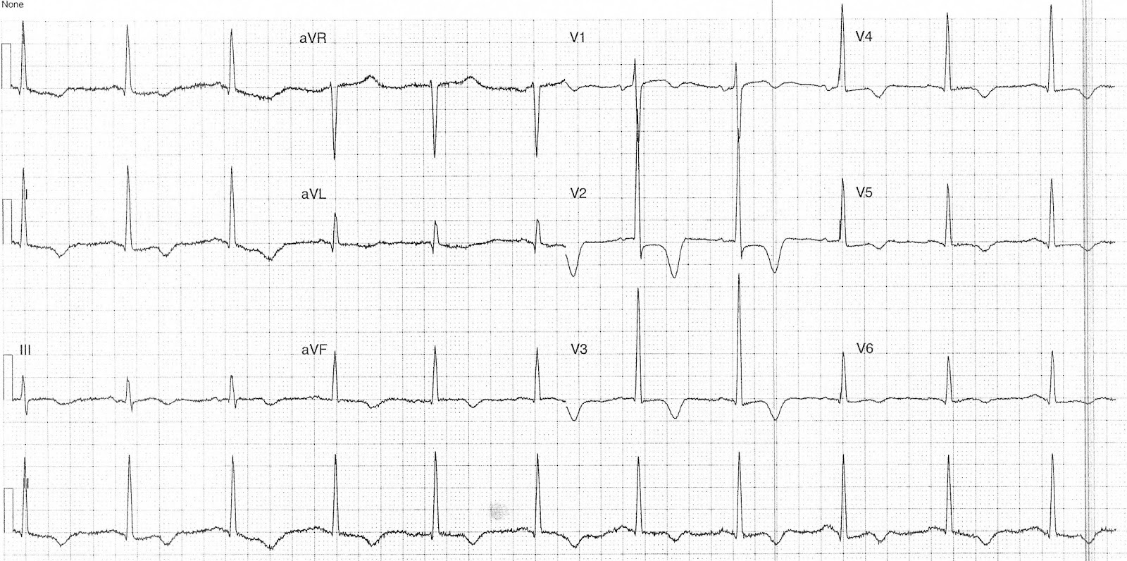 ECG of the Week: ECG of the Week - 24th August 2015 - Interpretation