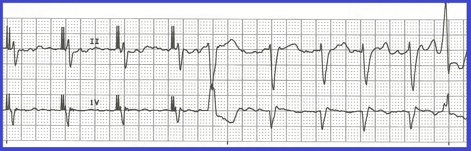 Practice EKG Rhythm Strips 128