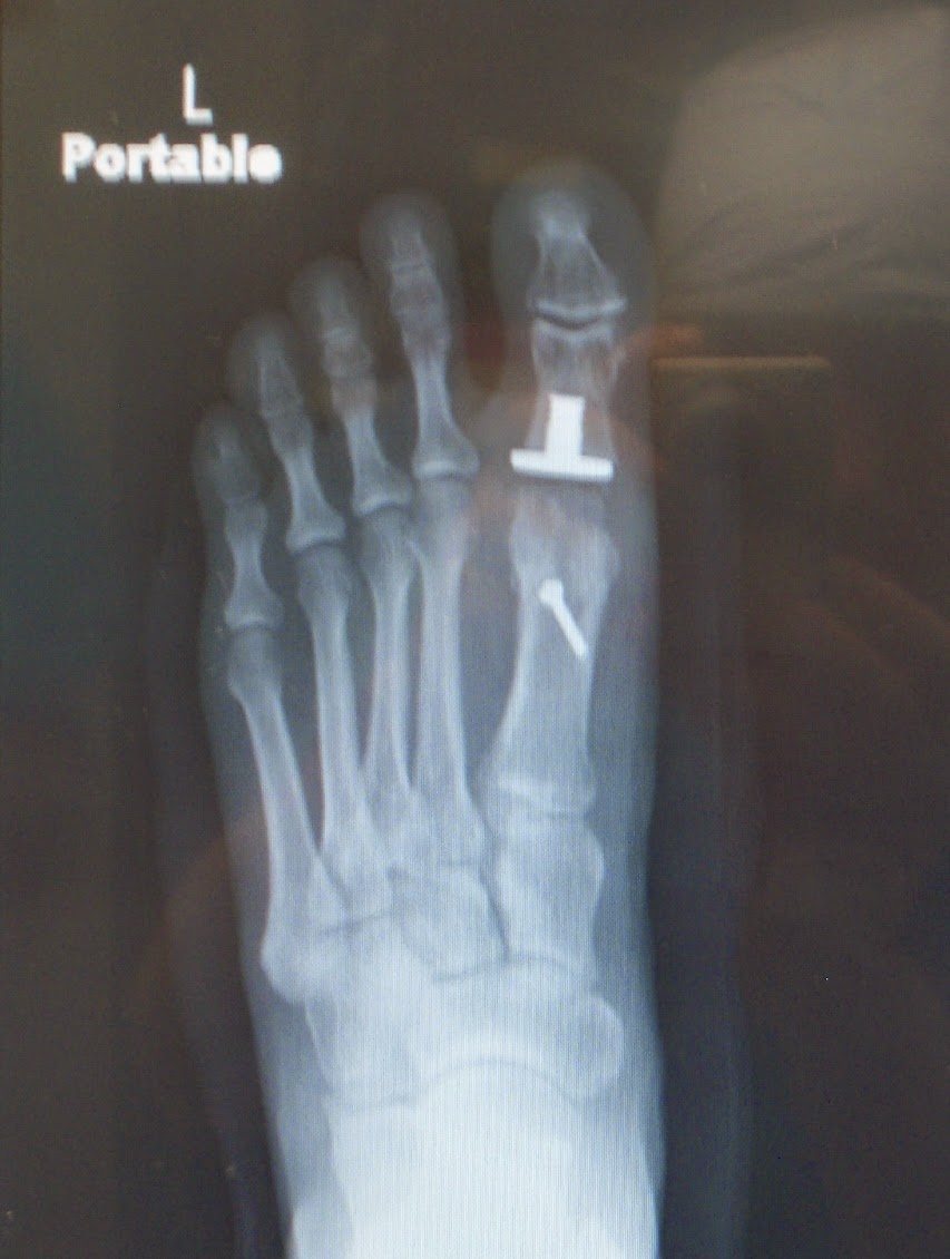 Podo Basas al Día: Operación de Hallux Límitus-Rígidus iatrogénico ...