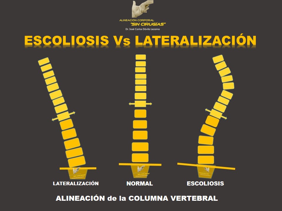 ESCOLIOSIS: Escoliosis Vs Lateralización de la Columna Vertebral ...