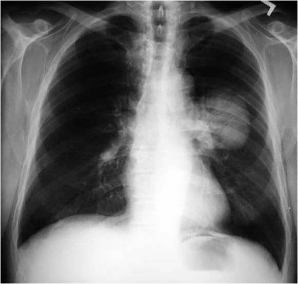 RADIOLOGY IMAGE SPOTTERS: Lung mass