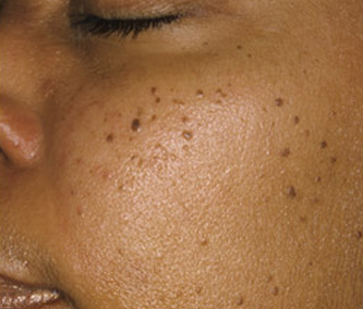 Photos of Skin Tags on Face ~ How To Remove Moles, Warts, Skin Tags Safely