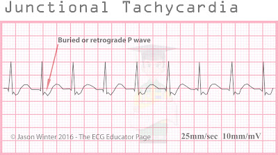 ECG Educator Blog : Junctional Rhythms