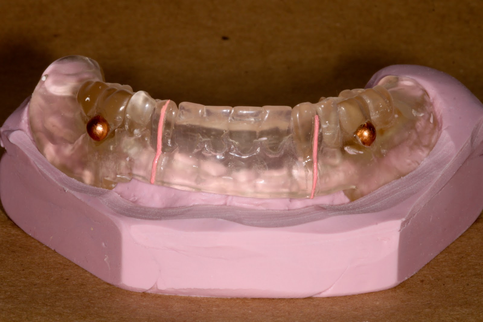 Boise Idaho Prosthodontics: Maxillary Complete Denture and Mandibular ...