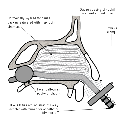 ENT for medical students: NOSE - Epistaxis