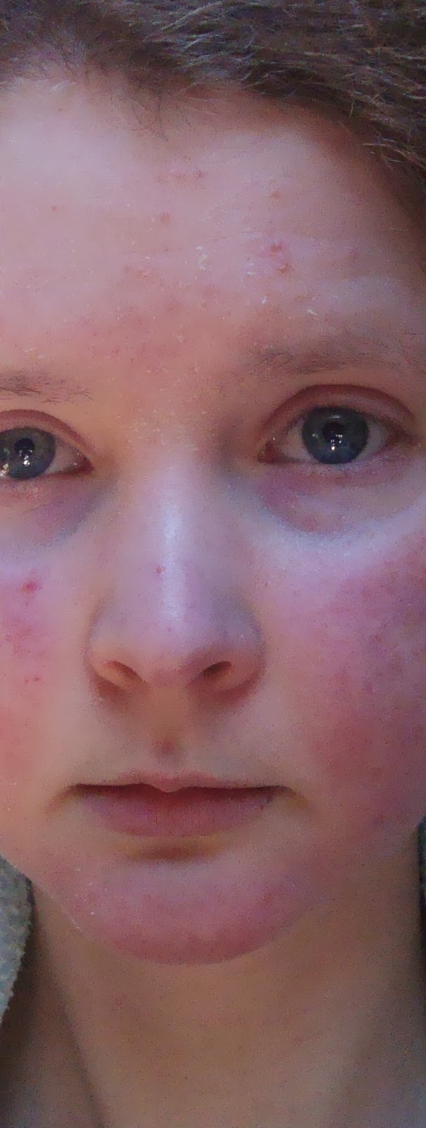 Scarlet Letters, dealing with vascular rosacea, face flushing, burning ...