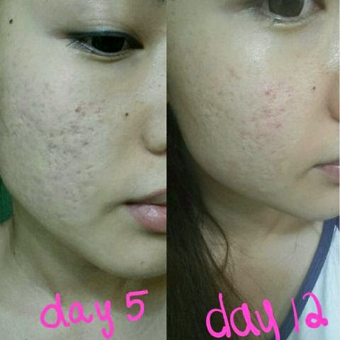 Cushing's Disease: Fading Acne Scars & My ACTH Stimulation Test