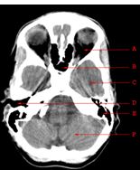 Dr Herry Setya Yudha Utama SpB. FInaCS. MHKes. ICS: Seri Bedah Saraf ...