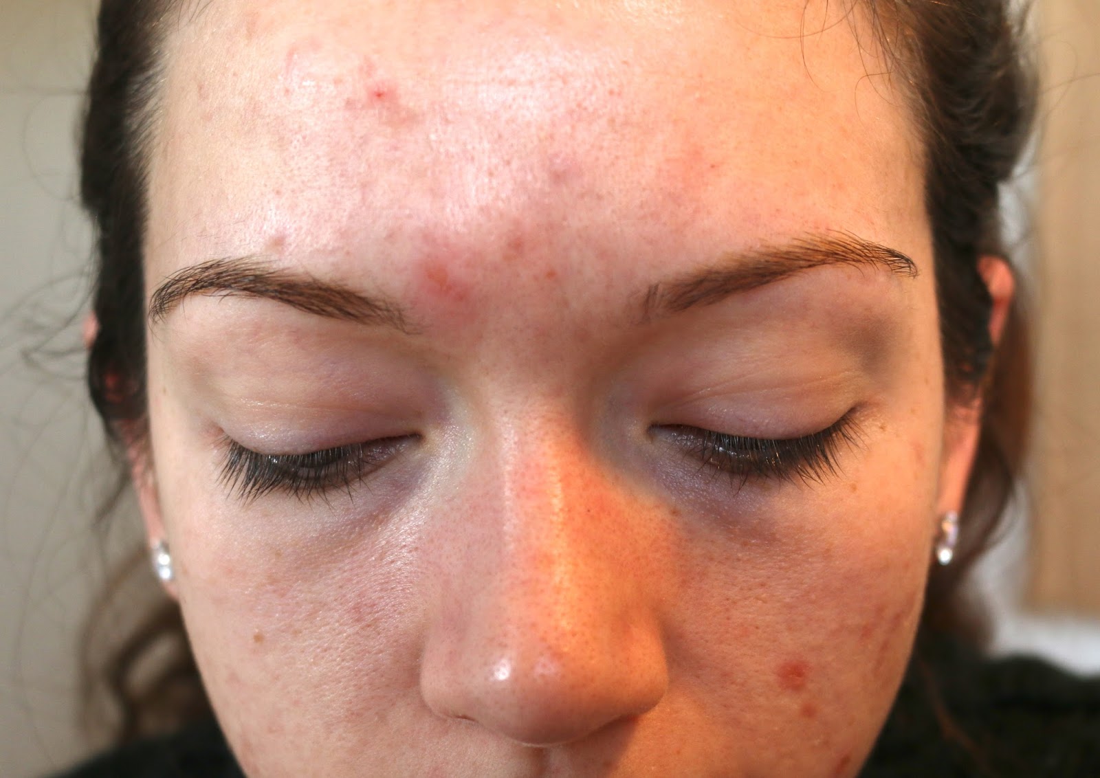 Why I Decided To Go On Roaccutane - Corrie Bromfield