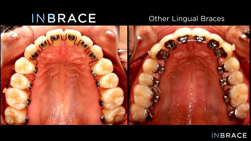 Lingual braces