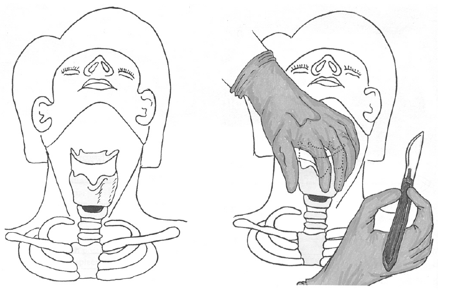 FORMAL CRICOTHYROIDOTOMY (SURGICAL) - Emergency Medicine