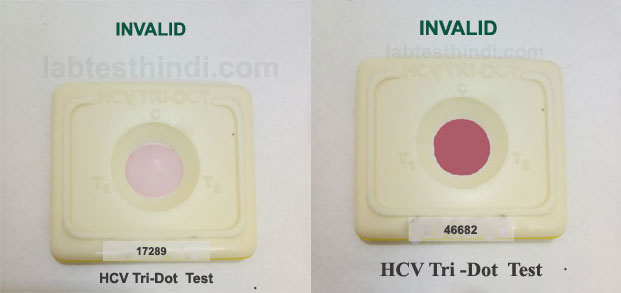 Hepatitis C ( HCV ) Test कैसे करते है ~ Lab Test Hindi