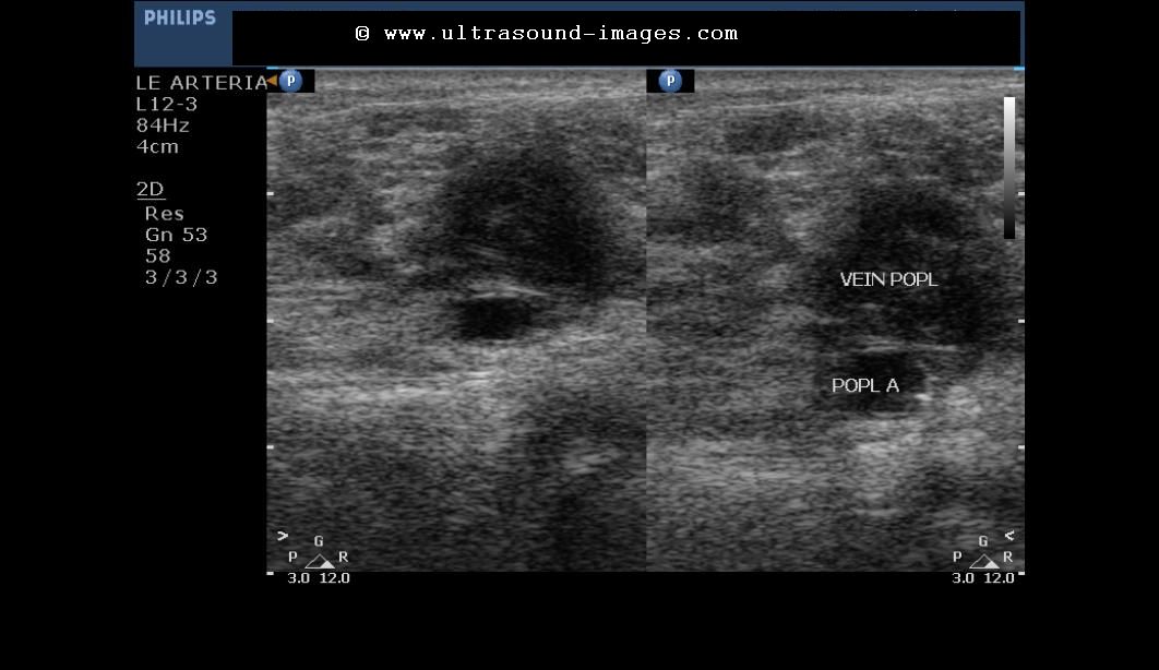 cochinblogs: Popliteal vein thrombosis- on arterial Doppler study