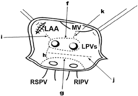Medical Treatment Pictures-for Better Understanding: Maze Procedure ...