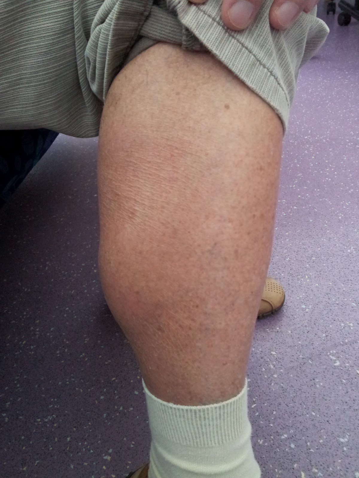 My Journey with Sarcoma