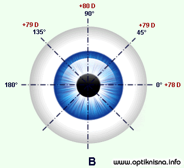 Astigmatism with The Rule and Againts The Rule