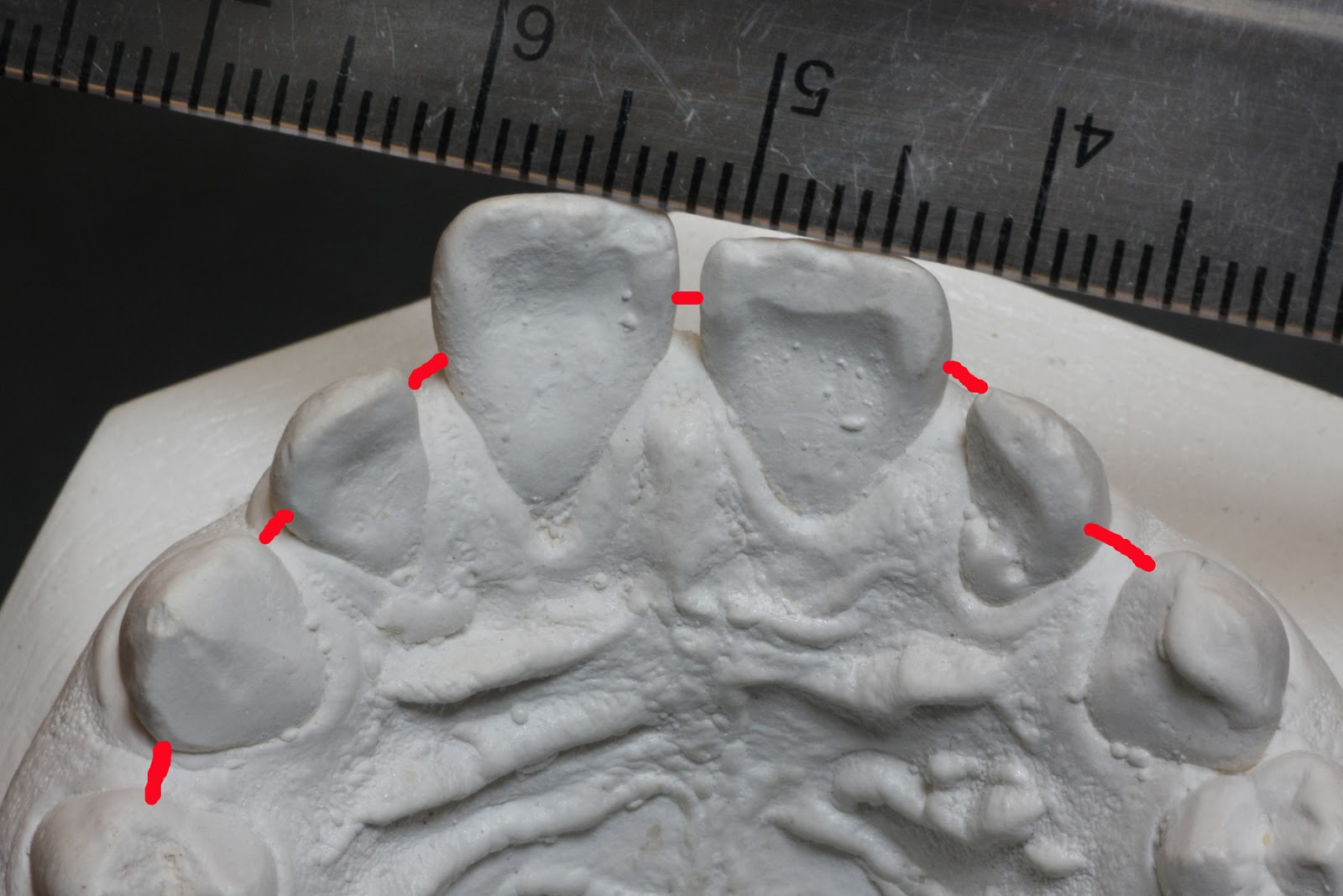 Orthodontics: UG Model Analysis Measurement of crowding and spacing