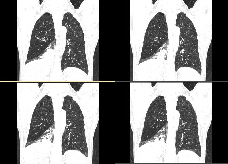 CXR 胸部x光判讀 right lower lobe (RLL) and right middle lobe (RML) collapse
