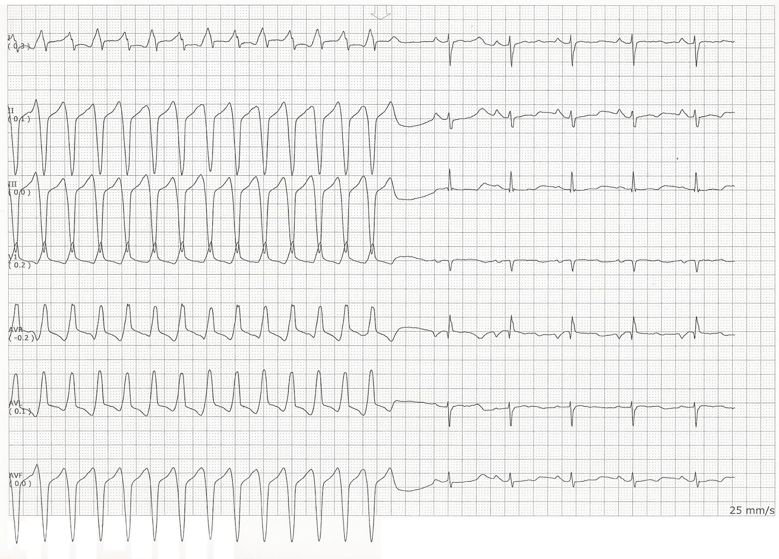 Float Nurse: Long Run of Ventricular Tachycardia