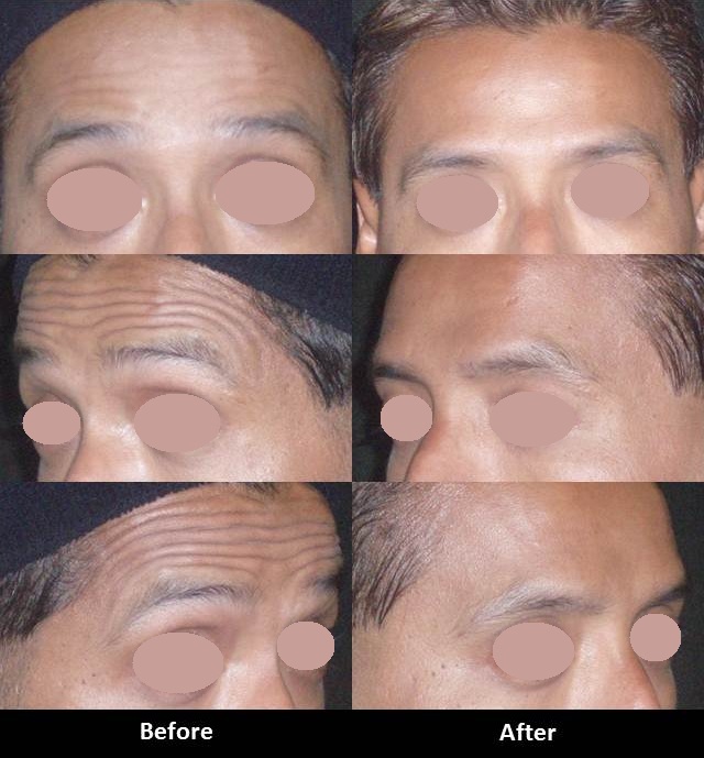 Dr. Alex's Blog: Botox Aftercare Instructions