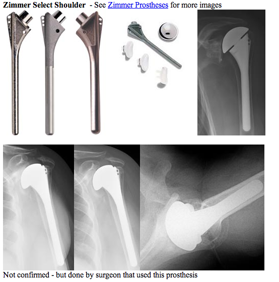 Shoulder and Elbow Surgery: Identifying the implanted shoulder ...