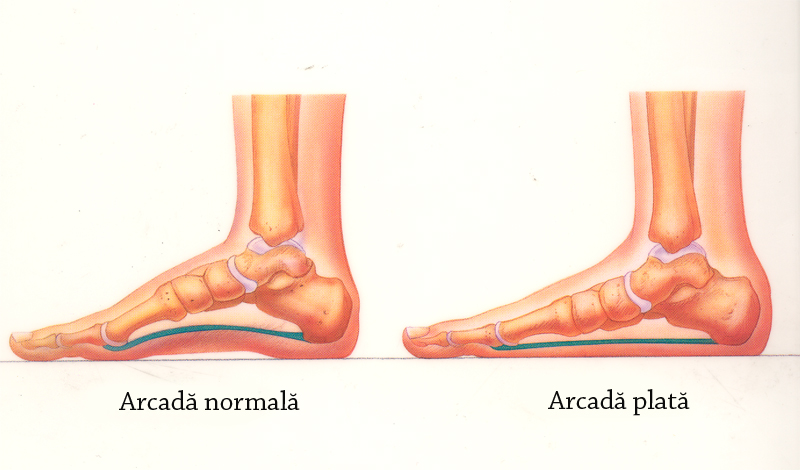 Platfusul - o afecțiune comuna?