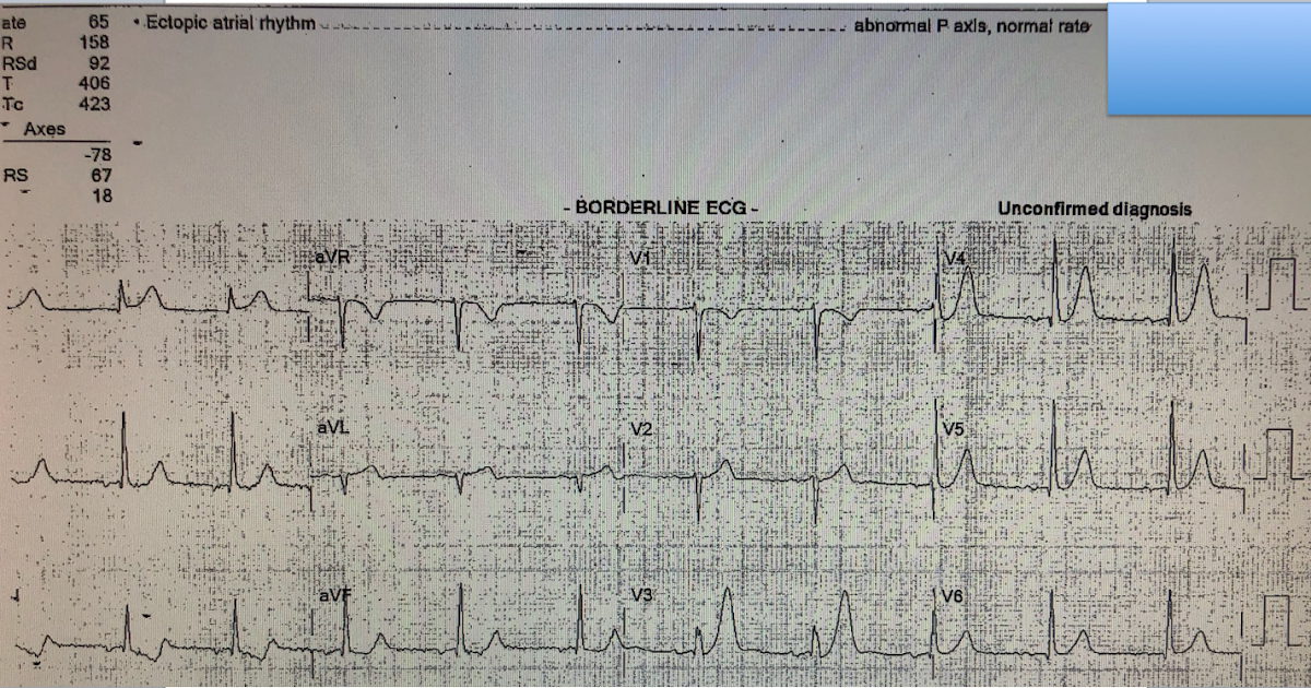 Dr. Smith's ECG Blog: It is not a STEMI; it is an opportunity to save ...