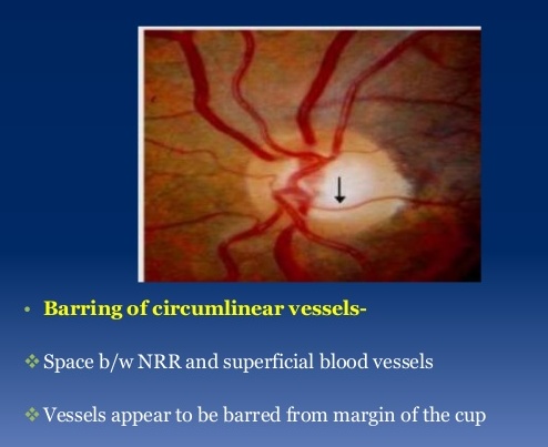 GLAUCOMA SPECIALIST BLOG: "THE GLOG"