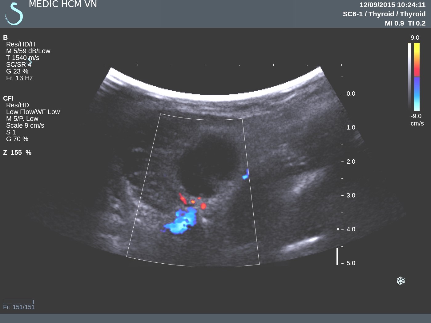 VIETNAMESE MEDIC ULTRASOUND: CASE 333: LUNG MASS, Dr PHAN THANH HẢI ...