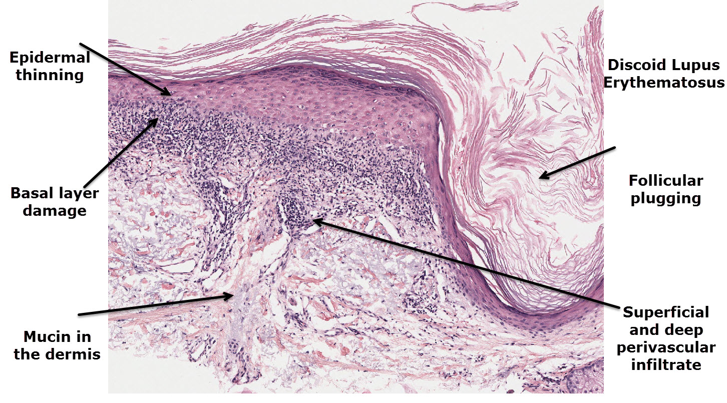 Dermatopathology Made Simple - Inflammatory: Interface - Vacuolar ...