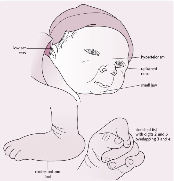 MẸO NHỚ: HỘI CHỨNG EDWARD | BLOG Y DƯỢC