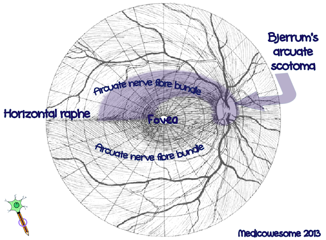 Medicowesome — Progression of visual field defects in Glaucoma...