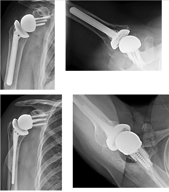 UW Shoulder and Elbow Academy: Reverse total shoulder - progressive ...