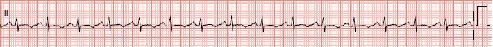 EKG Rhythm Strips 15: Sinus Rhythms