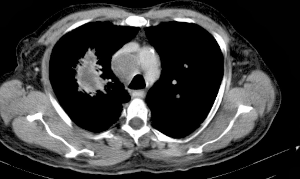 Ultimate Radiology : Case Of Ca Lung