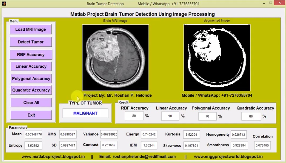 Brain Tumor Detection On Mri Images Using Segmentation And Clustering Full Matlab Project Code