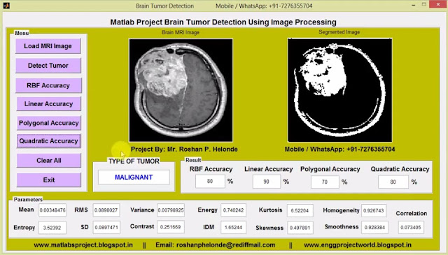 Brain Tumor Detection on MRI Images Using Segmentation and Clustering Full Matlab Project Code ...