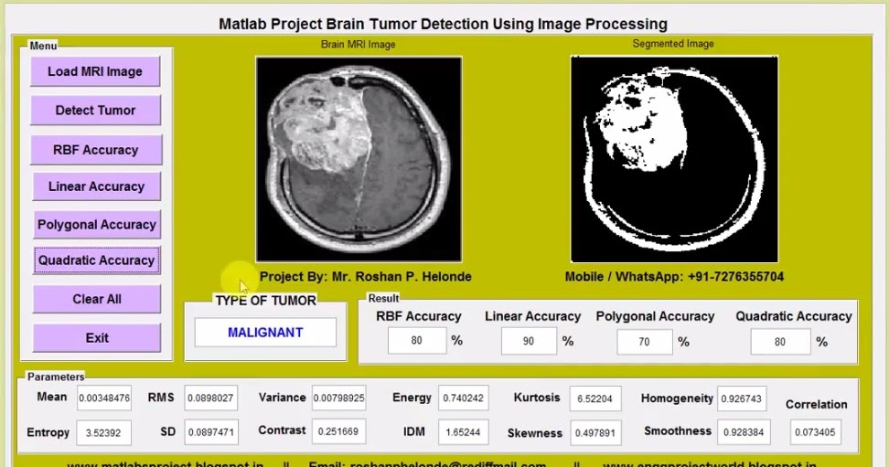 Brain Tumor Detection on MRI Images Using Segmentation and Clustering Full Matlab Project Code ...