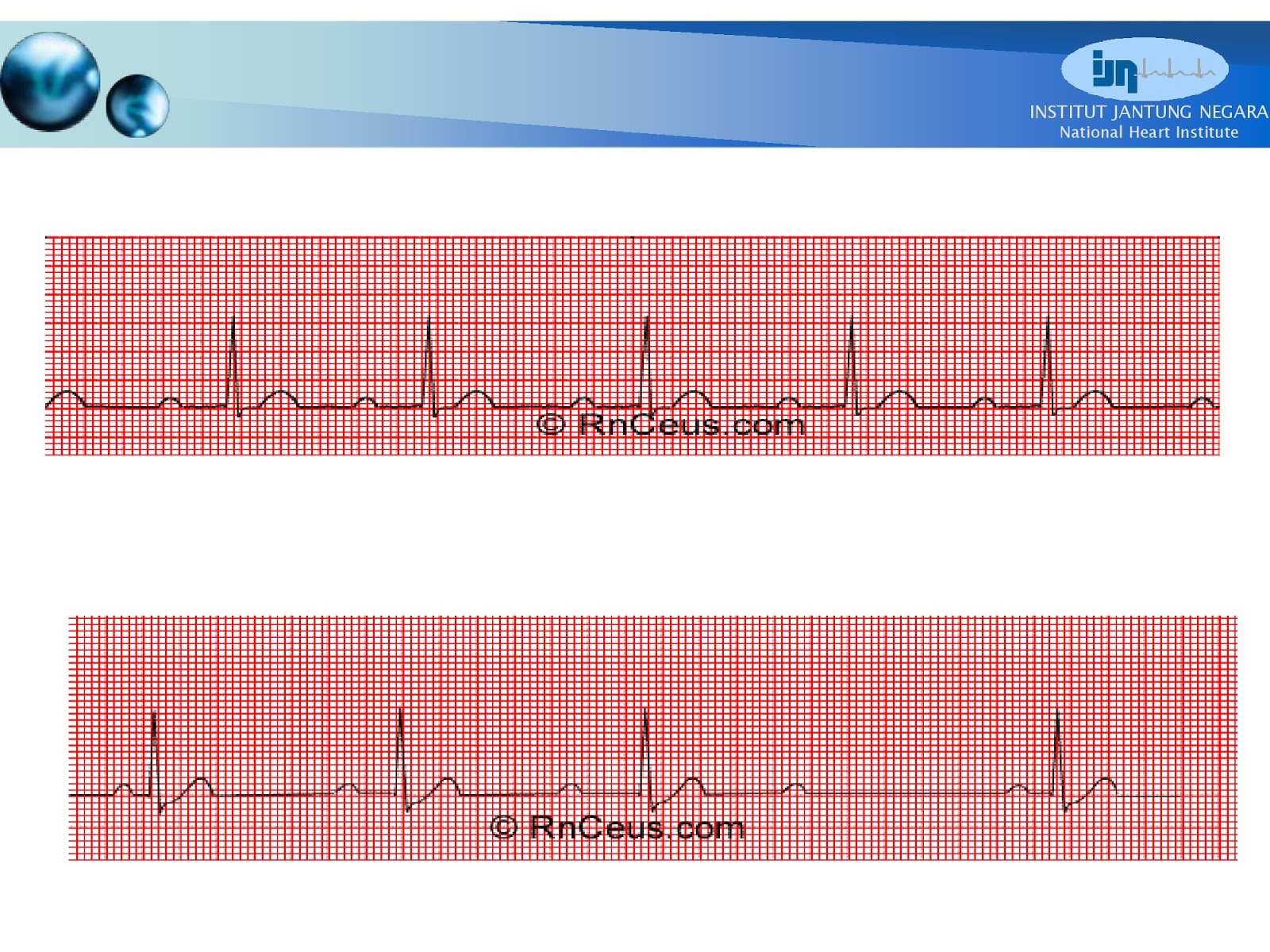 CVT Mohd Farid: Basic ECG Part III-P Wave & PR Interval