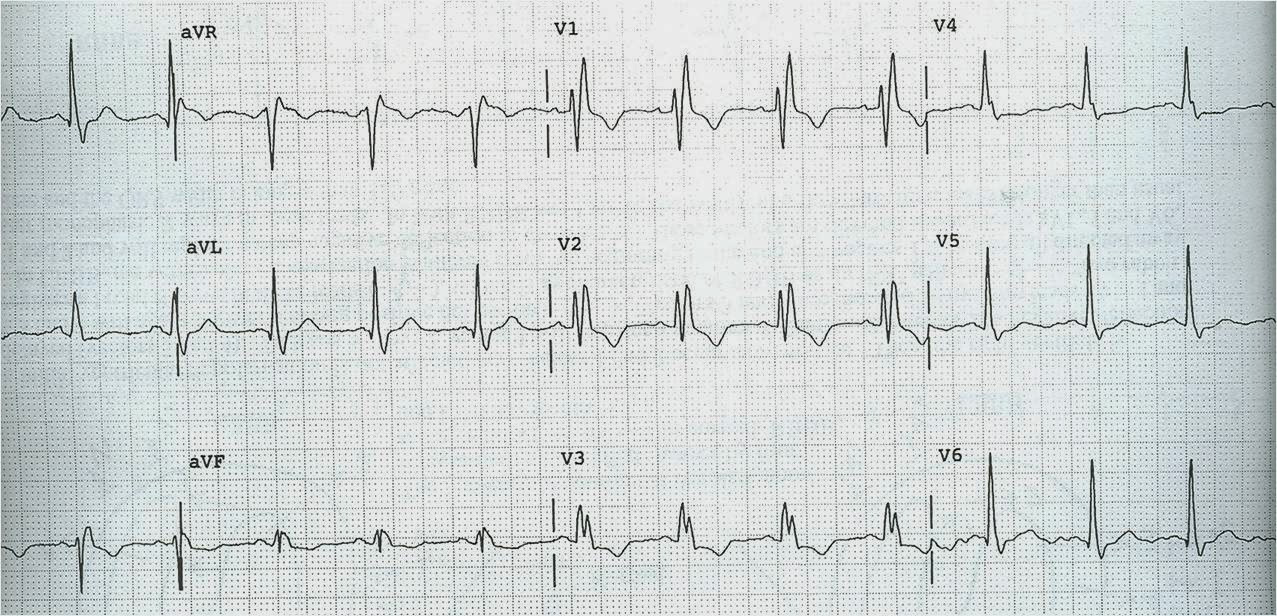 Dr. Smith's ECG Blog: Left ventricular Aneurysm Morphology Distorted by ...